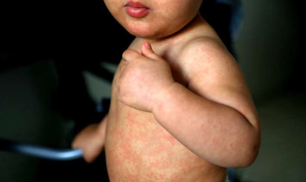 México emite aviso epidemiológico ante aumento de sarampión en las ...